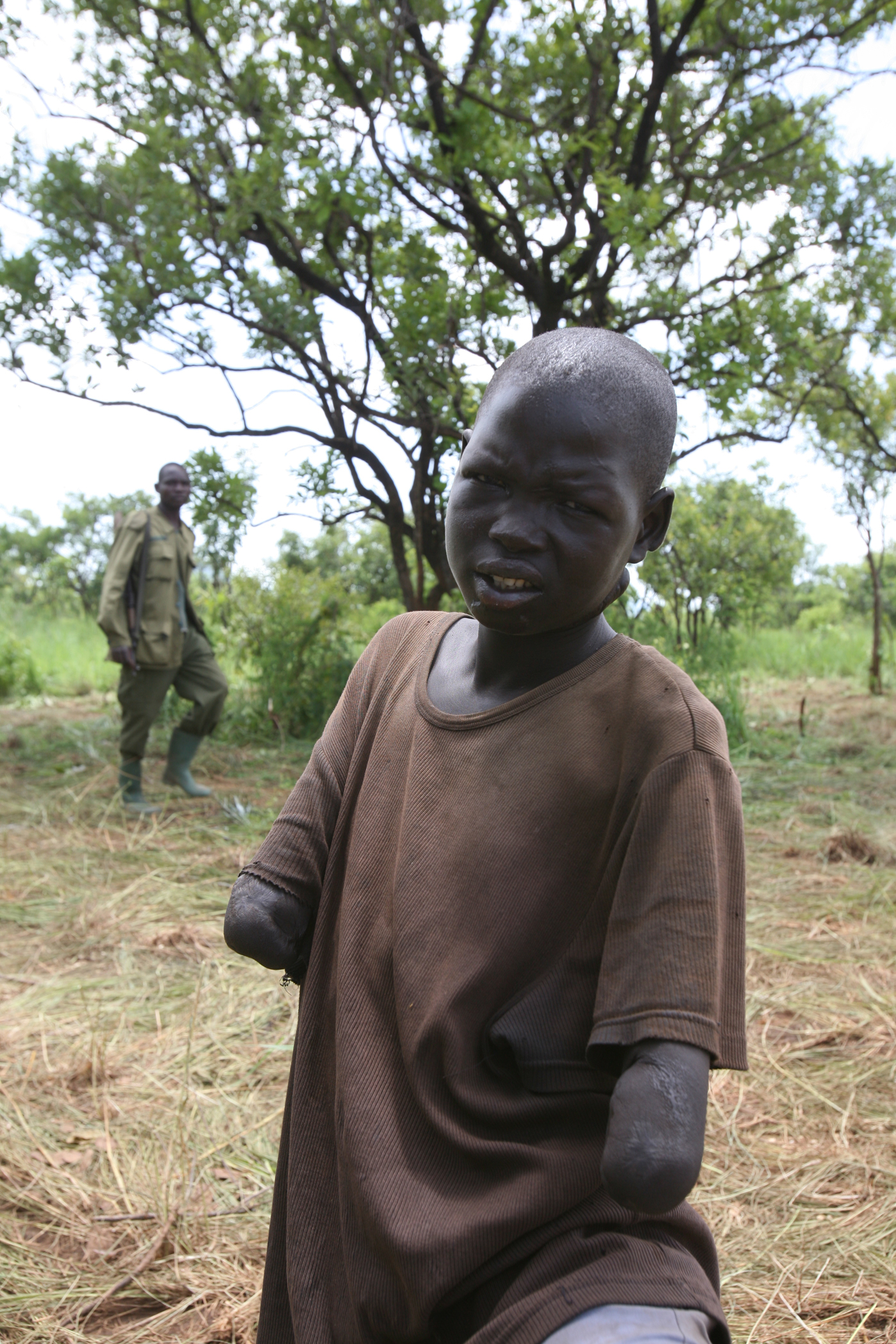 A young boy poses for a photo showing his mutilated limbs, Kitgum ...