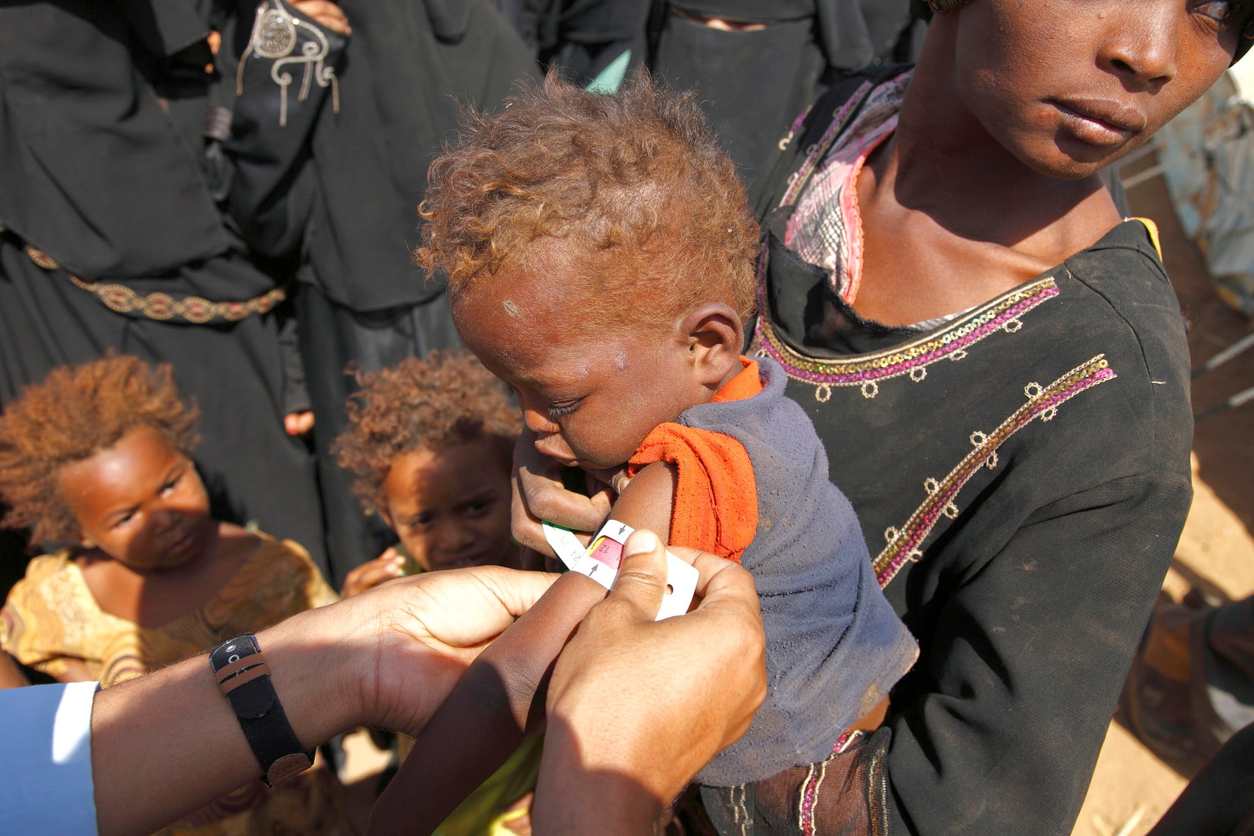 A UNICEF doctor performs a check for malnutrition on this one year old ...